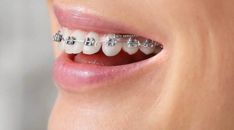 TADs (Temporary Anchorage Device) - Foley & Le Oral Surgery ...