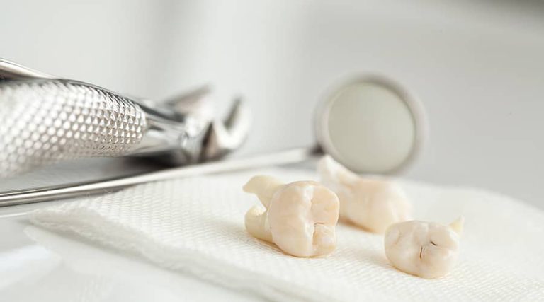 Multiple Tooth Extractions - Foley & Le Oral Surgery | Tooth ...