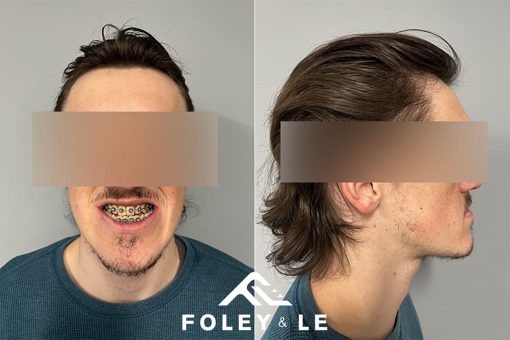 Open bite | open bite jaw surgery | Foley & Le Oral Surgery