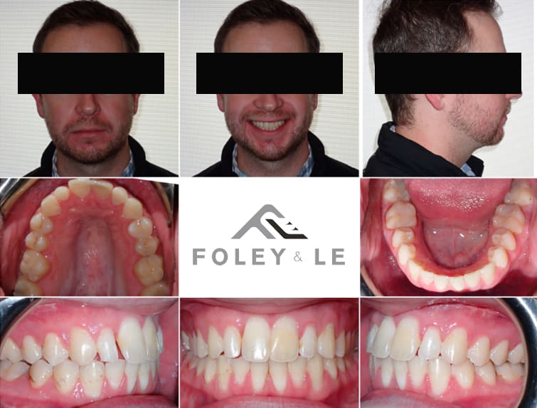 How to correct a severe overbite | Foley & Le Oral Surgeons