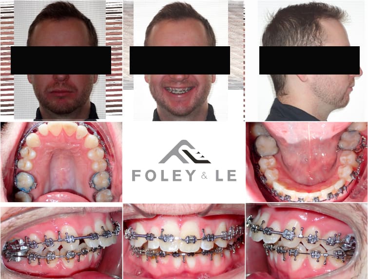 How to correct a severe overbite | Foley & Le Oral Surgeons